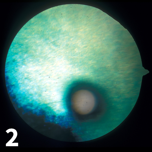 Top 5 Classifications of Blindness | Clinician's Brief