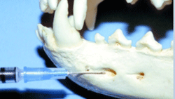 Peripheral Nerve Block Techniques: Dental Blocks | Clinician's Brief