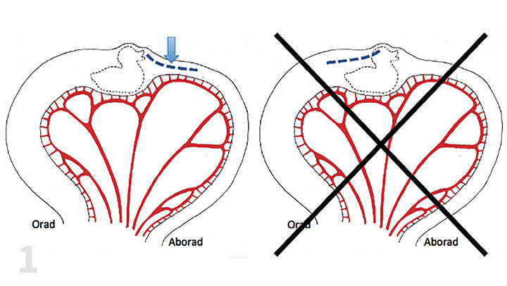 Intestinal Incision Dehiscence | Clinician's Brief
