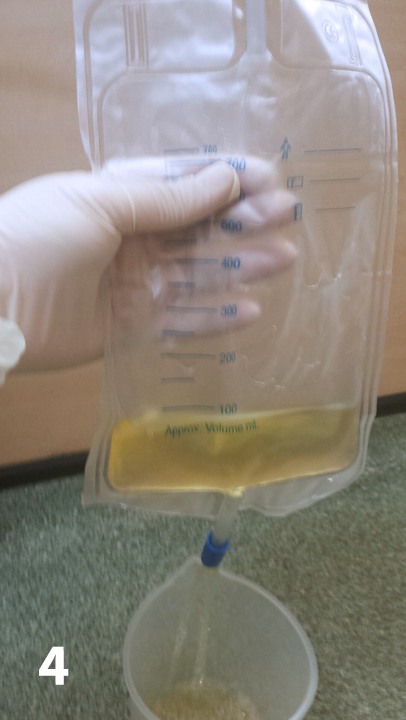 Managing Indwelling Urinary Catheters | Clinician's Brief