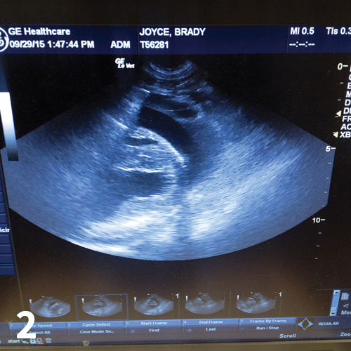 Pericardiocentesis | Clinician's Brief