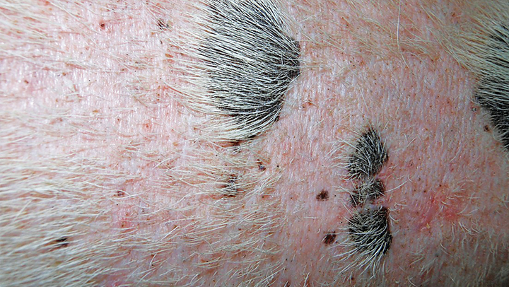 Top 5 Dermatoses Associated with Electromagnetic Radiation | Clinician ...