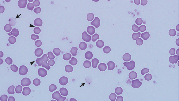 RBC Morphology Interpretation & Blood Film Review | Clinician's Brief