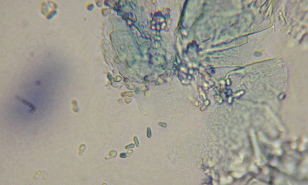 Chronic Otitis Externa | Clinician's Brief