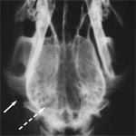 Bulla Radiography | Clinician's Brief