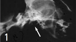 Bulla Radiography | Clinician's Brief