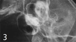 Bulla Radiography | Clinician's Brief