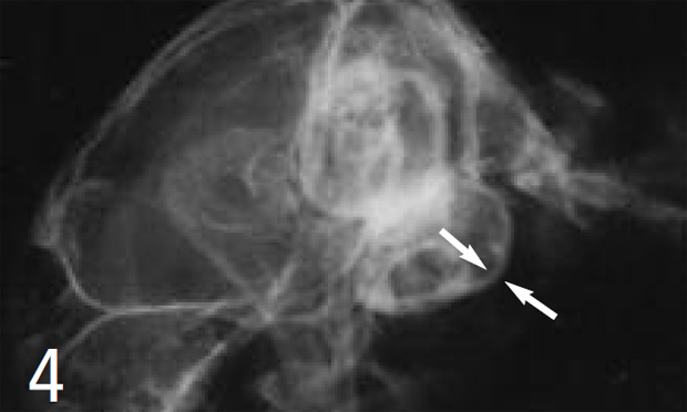 Bulla Radiography | Clinician's Brief