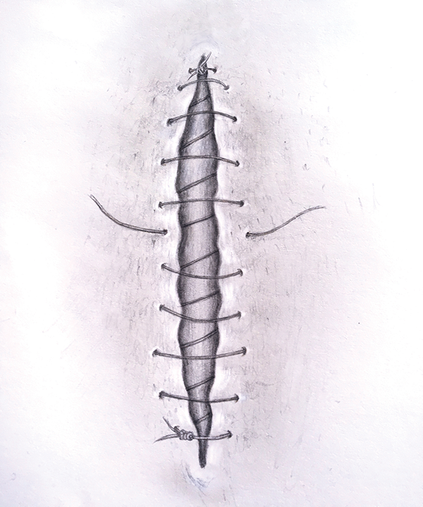 Tensioning Sutures for Open Wounds | Clinician's Brief