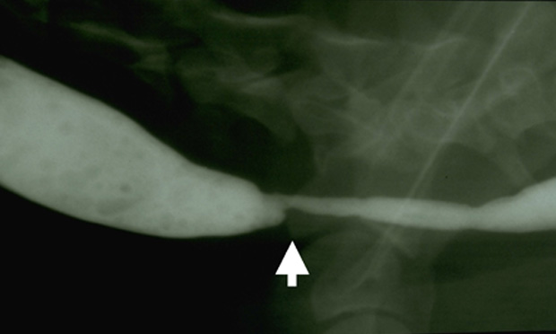 Reflux Esophagitis | Clinician's Brief