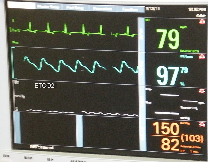 Anesthetic Monitoring: Interpreting the Readings | Clinician's Brief
