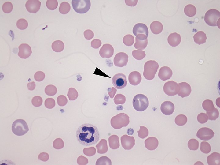 Normoblastemia in Association with Cancer & Chemotherapy | Clinician's ...