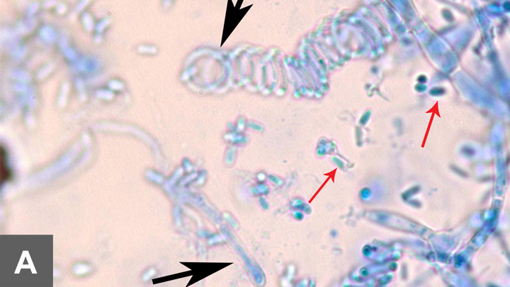 Microscopic Examination of Fungal Cultures | Clinician's Brief