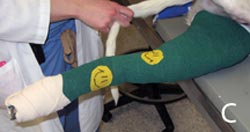 Managing Degloving & Shearing Injuries | Clinician's Brief