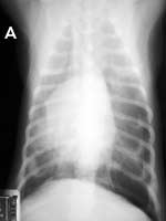 Detection & Treatment of Pneumothorax | Clinician's Brief