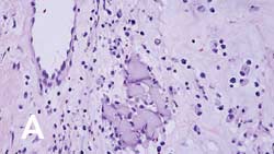Feline Injection-Site Sarcoma | Clinician's Brief