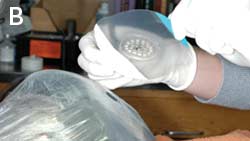 Vacuum-Assisted Wound Closure | Clinician's Brief