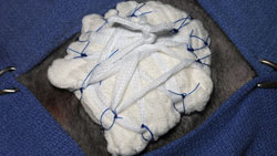 Wound Management: Tie-Over Bandages | Clinician's Brief