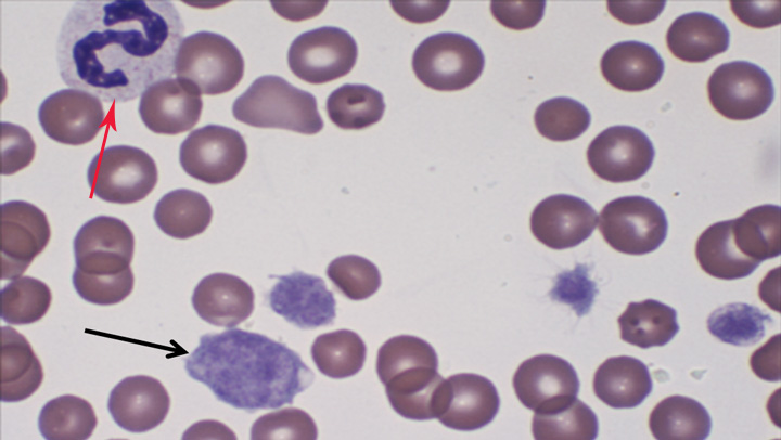Macrothrombocytopenia in a Cavalier King Charles Spaniel | Clinician's ...