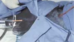 How To Place An Esophagostomy Tube | Clinician's Brief