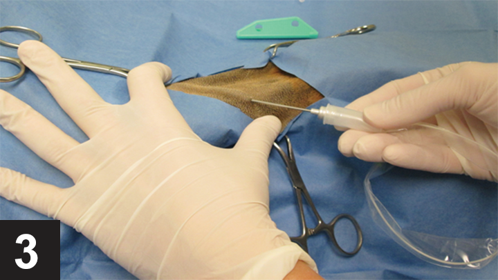 Placing a Central Sampling Catheter Through a Peripheral Vein ...