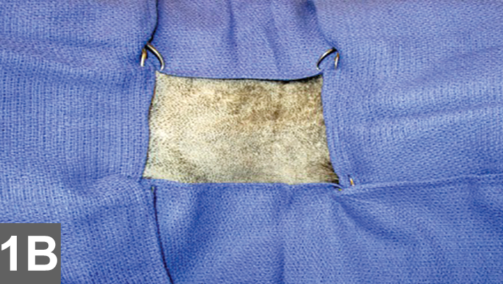 Central Venous Catheter Placement: Modified Seldinger Technique ...