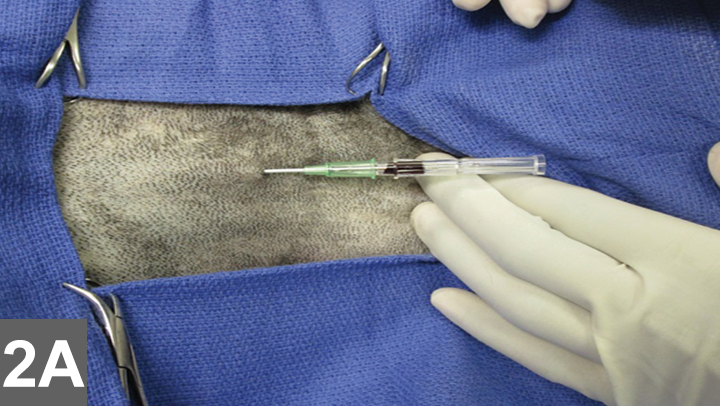 Central Venous Catheter Placement: Modified Seldinger Technique ...