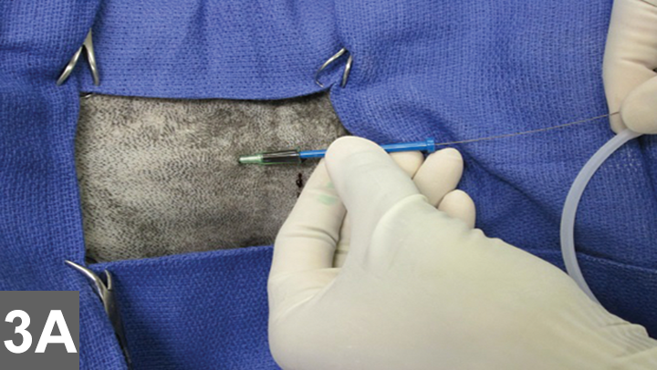 Central Venous Catheter Placement: Modified Seldinger Technique ...