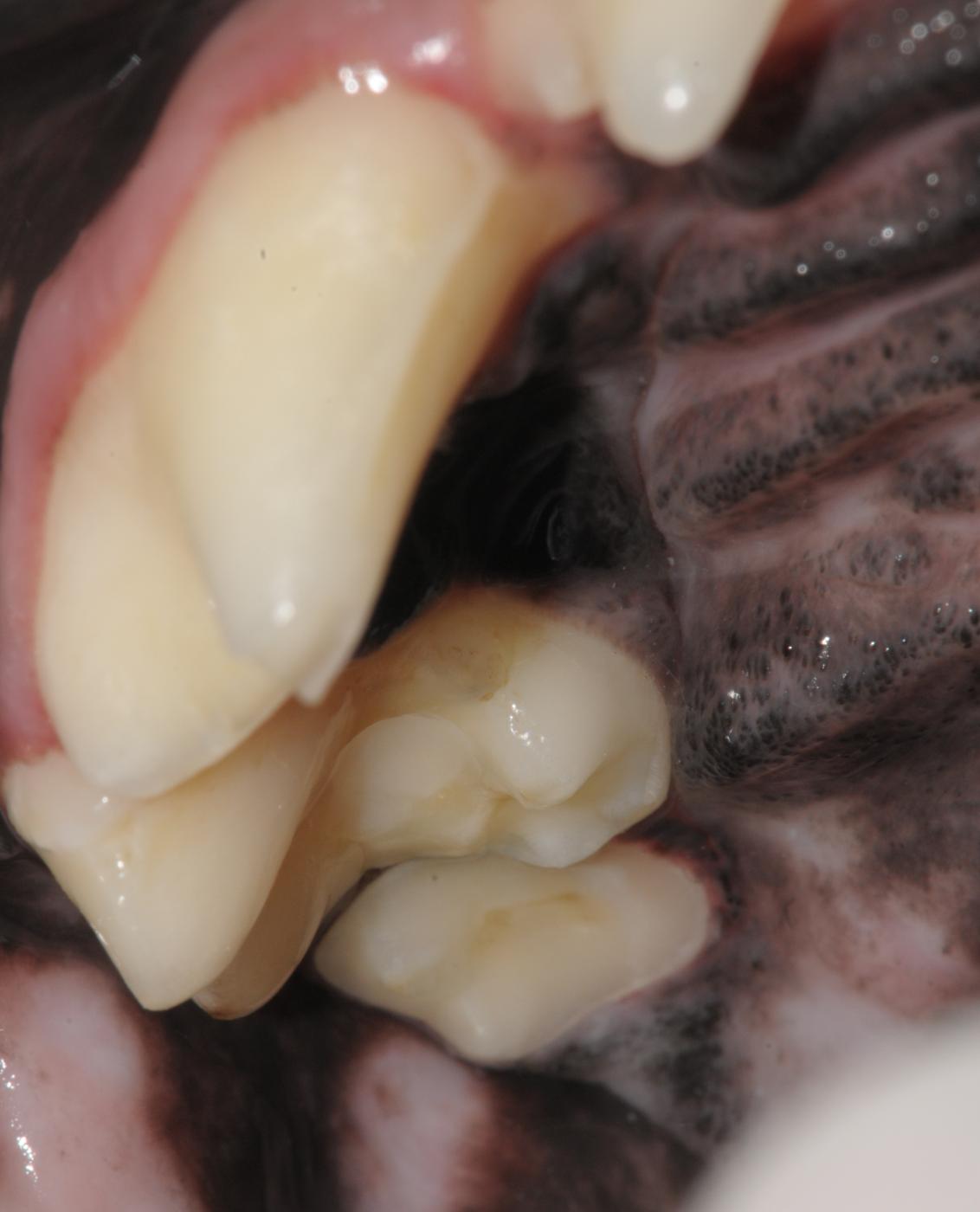 Crown Lesions and Associated Treatments | Clinician's Brief