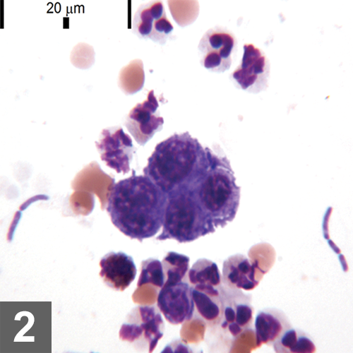 Atypical Transitional Epithelial Cells | Clinician's Brief