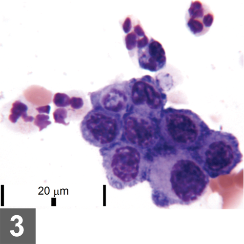 Transitional Epithelial Cells In Urine