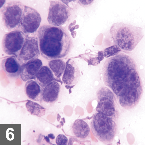 Atypical Transitional Epithelial Cells | Clinician's Brief