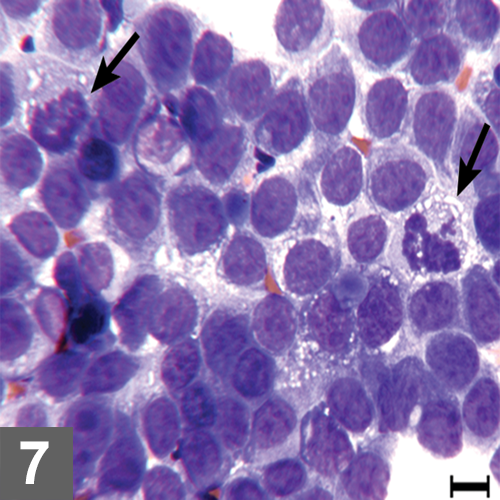 Atypical Transitional Epithelial Cells | Clinician's Brief