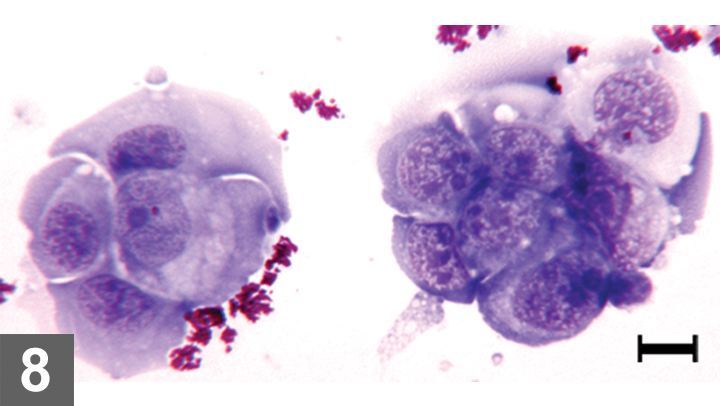 Atypical Transitional Epithelial Cells | Clinician's Brief