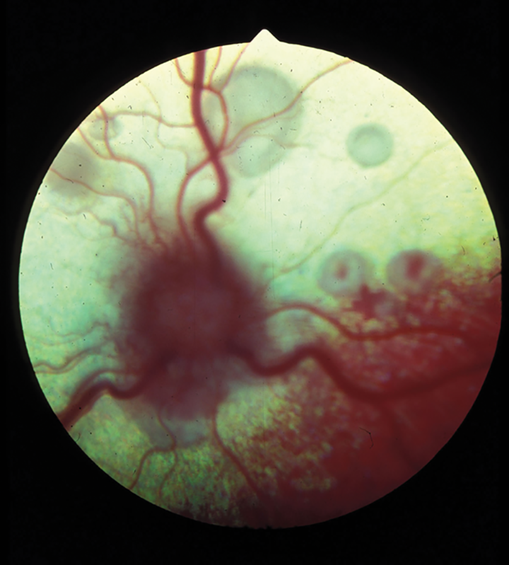 Chorioretinitis | Clinician's Brief