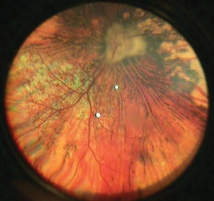 Chorioretinitis | Clinician's Brief