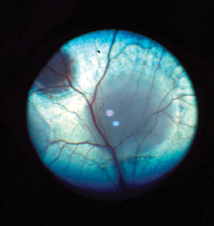 Chorioretinitis | Clinician's Brief