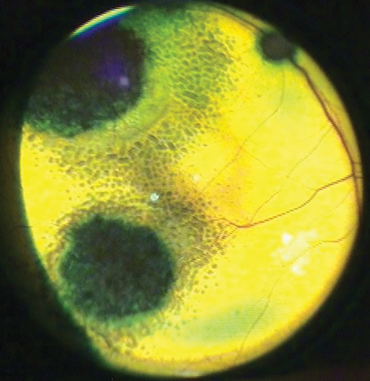 Chorioretinitis | Clinician's Brief