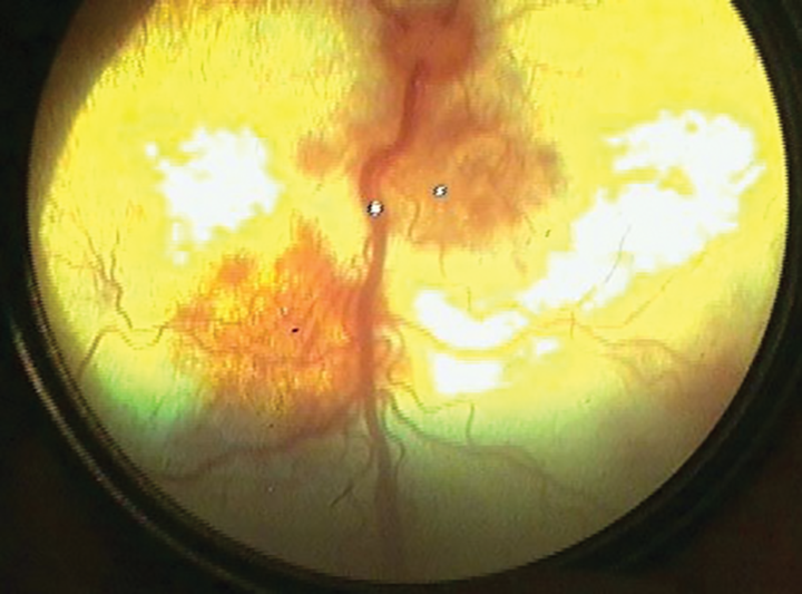 Chorioretinitis | Clinician's Brief
