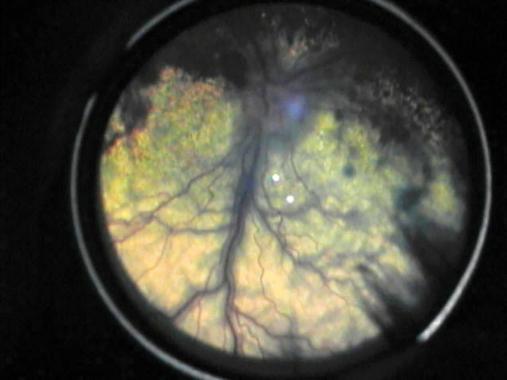 Chorioretinitis | Clinician's Brief