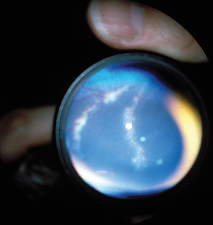 Chorioretinitis | Clinician's Brief