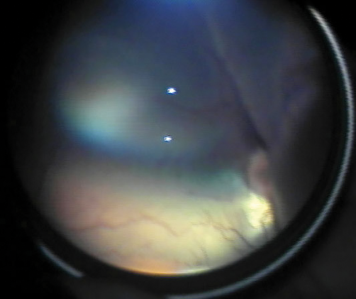 Chorioretinitis | Clinician's Brief