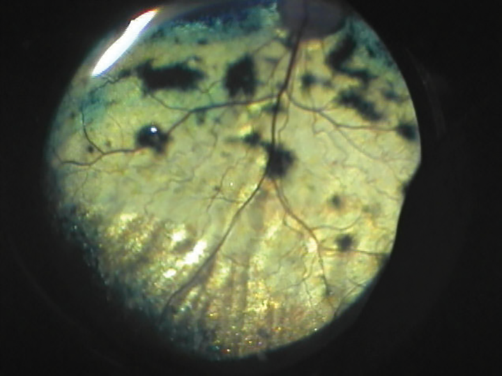 Chorioretinitis | Clinician's Brief