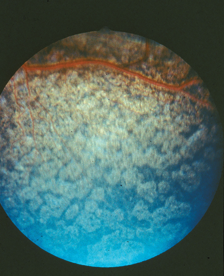 Chorioretinitis | Clinician's Brief