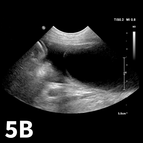 Abdominal Focused Assessment with Sonography for Trauma | Clinician's Brief