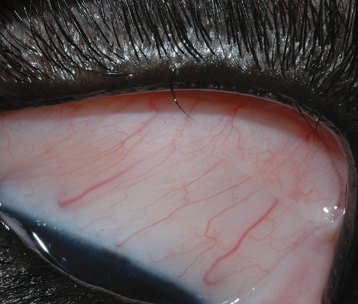 Distichiasis | Clinician's Brief