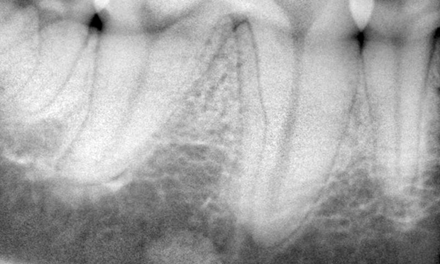How to Interpret Dental Radiographs | Clinician's Brief