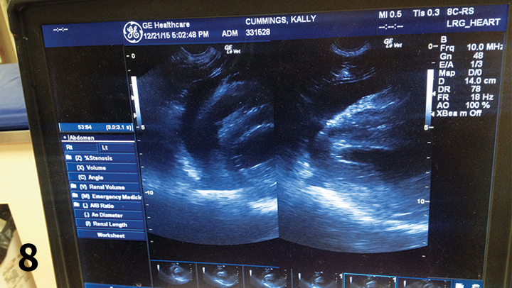 Pericardiocentesis | Clinician's Brief