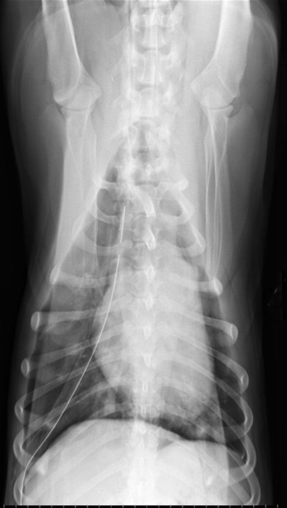 Chest Tube Placement | Clinician's Brief