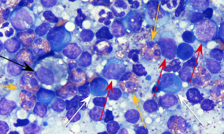 Image Gallery: Lymph Node Cytology | Clinician's Brief